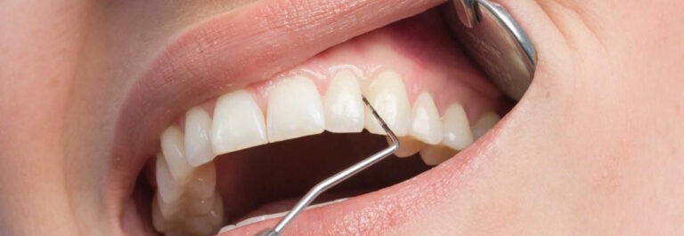 Greffe de gencive | Odontopole | Clinique dentaire à Arras